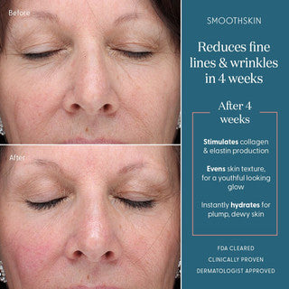 Best Way to Reduce or Remove Wrinkles – SmoothSkin US